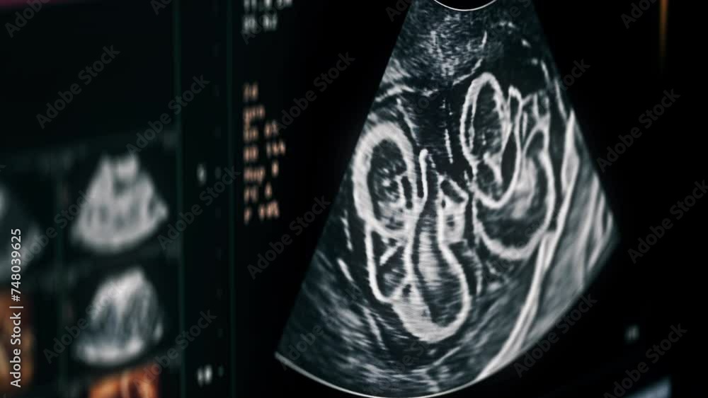 Motherhood Medical X-Ray Scan Identifying Twin Babies In Womb ...