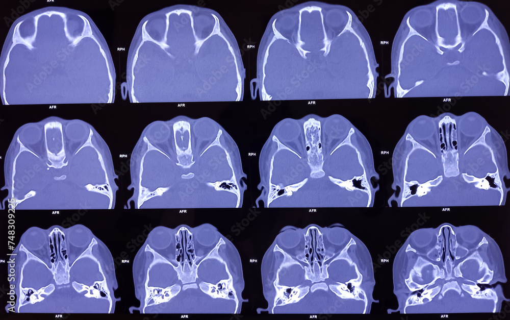 CT scan brain and orbit: It's very useful to diagnose stroke, trauma ...