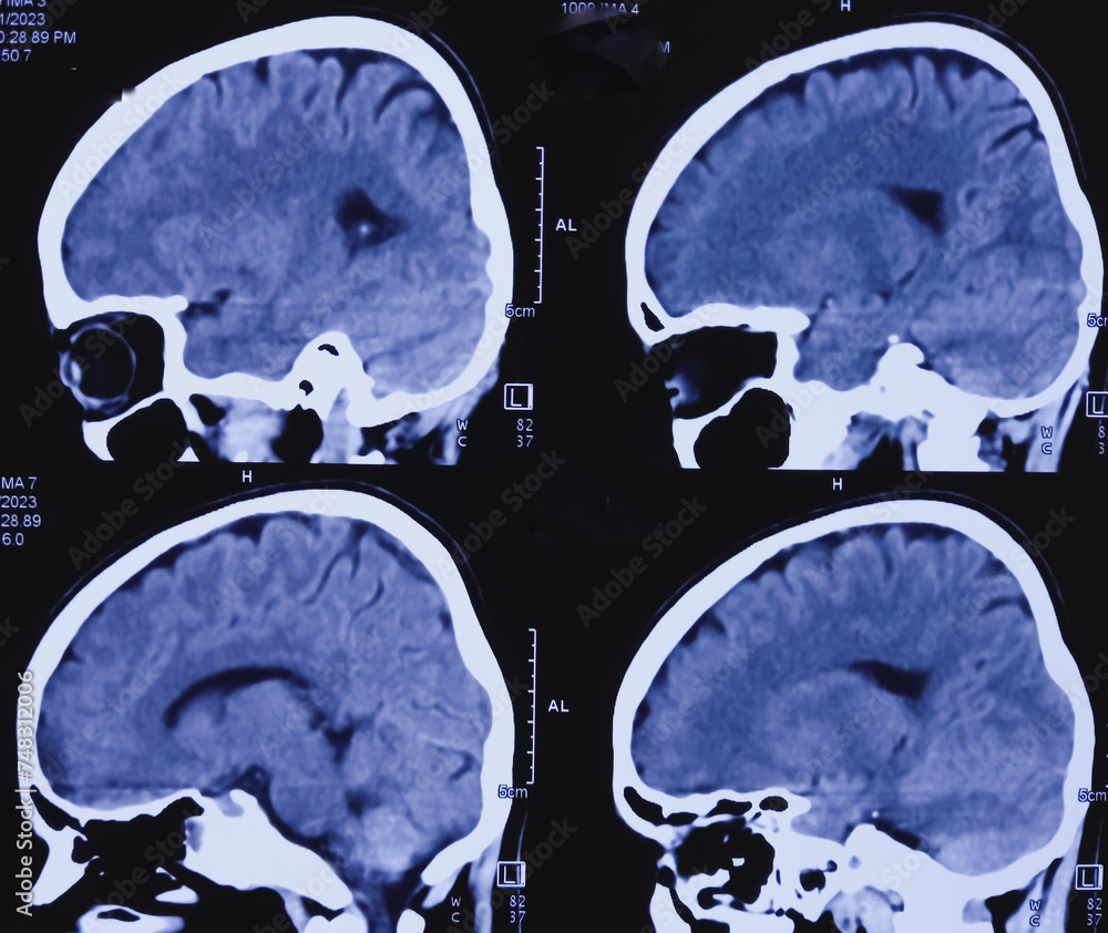 CT scan of PNS and Head: Hypertrophied both inferior nasal turbinates ...