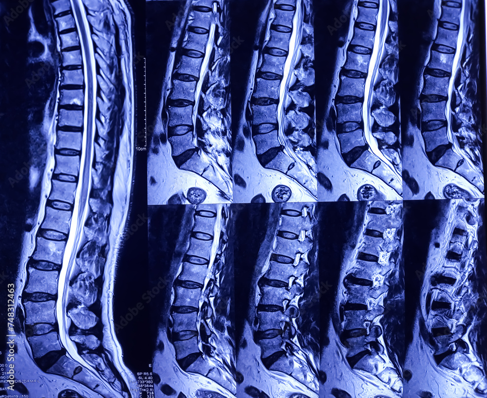 MRI (magnetic resonance imaging) of Lumbo sacral Spine. L4-L5 and L5-S1 ...