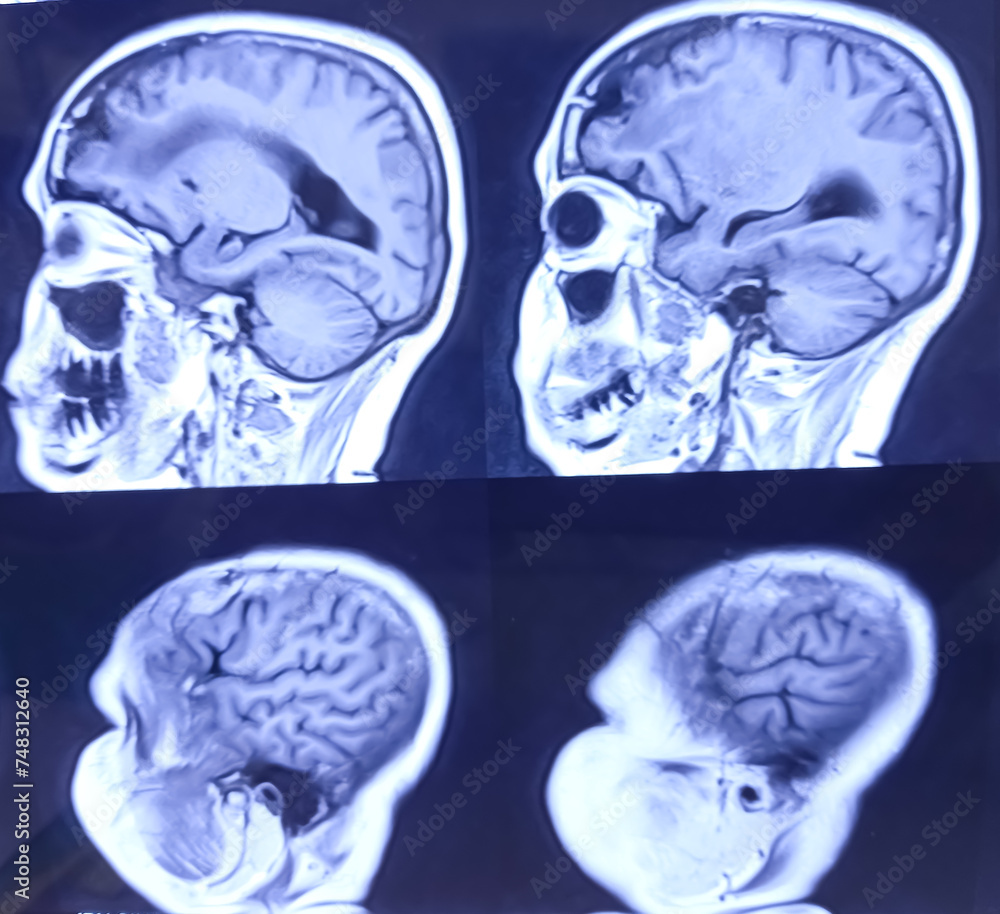 CT scan of PNS and Head: Hypertrophied both inferior nasal turbinates ...