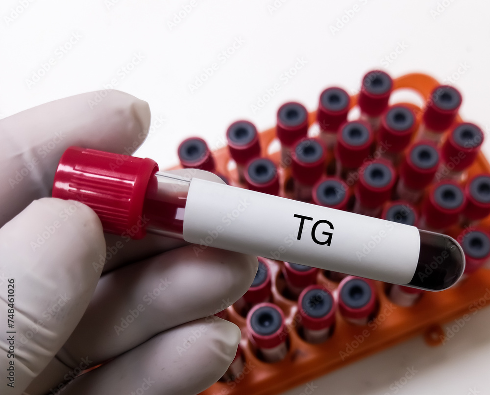 Blood sample for Triglycerides (Tg) test, to risk of heart disease and ...
