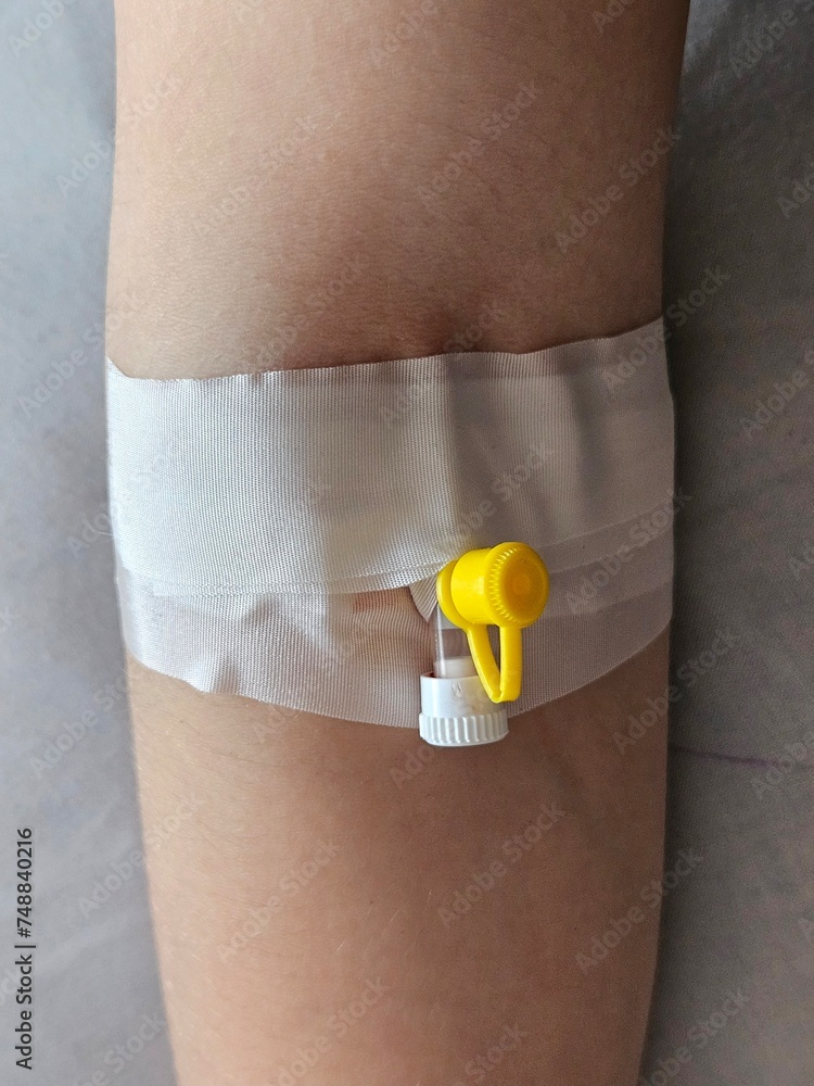 catheter for blood test. catheter in a vein in a patient. Image of a ...