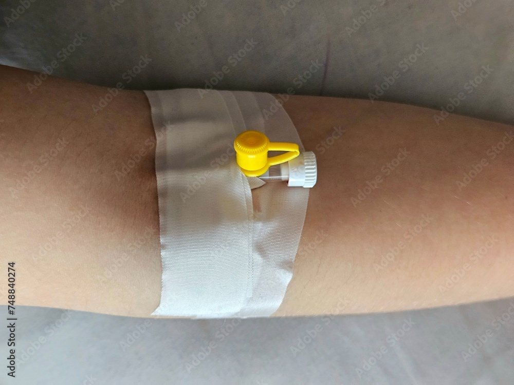 catheter for blood test. catheter in a vein in a patient. Image of a ...
