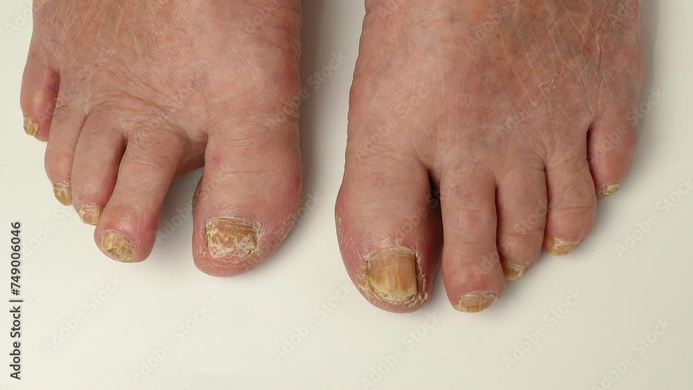 Toenail fungus. Nails affected by a fungal infection. Onycholysis of ...