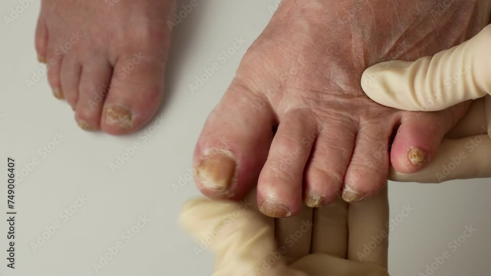 Toenail fungus. A podologist examines toenails affected by a fungal ...