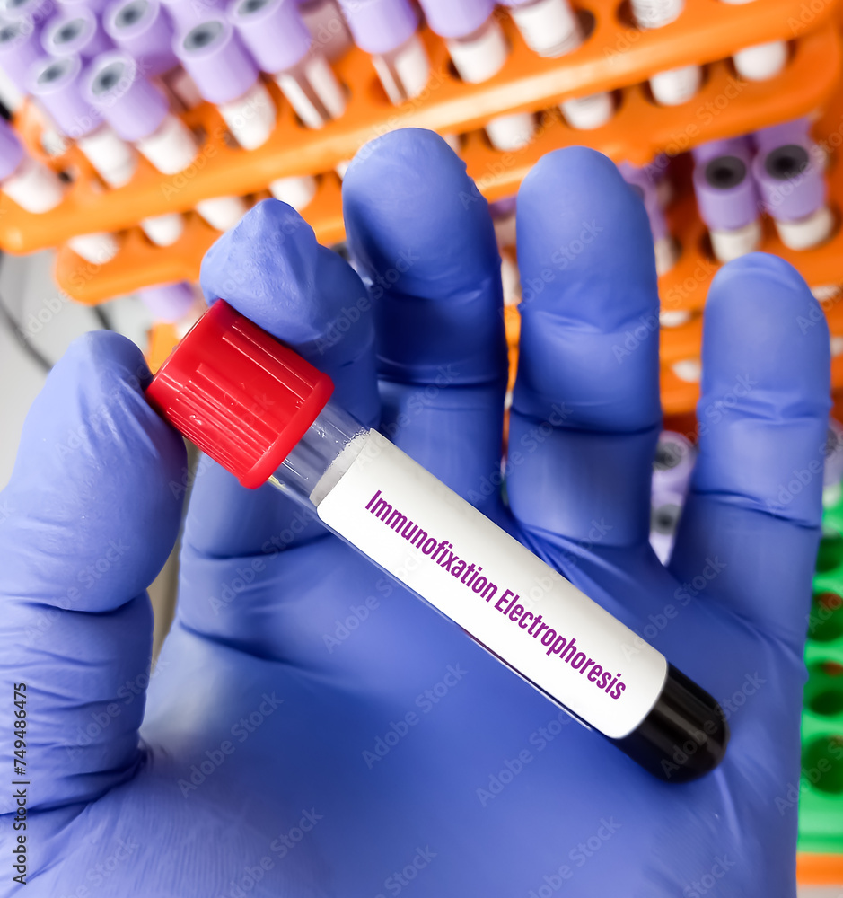 Blood sample for IFE (immunofixation electrophoresis) blood test, to ...