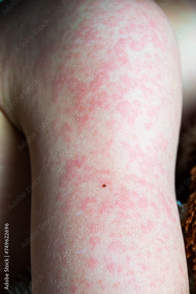 Viral disease. Measles rash on the body of the child. Allergy Stock ...