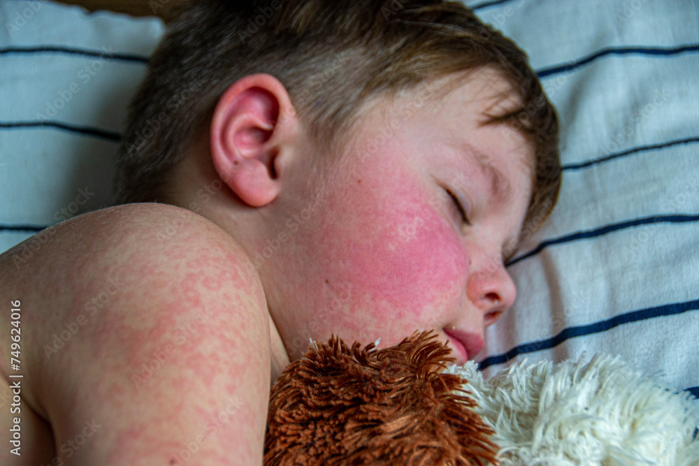 Viral disease. Measles rash on the body of the child. Allergy Stock ...