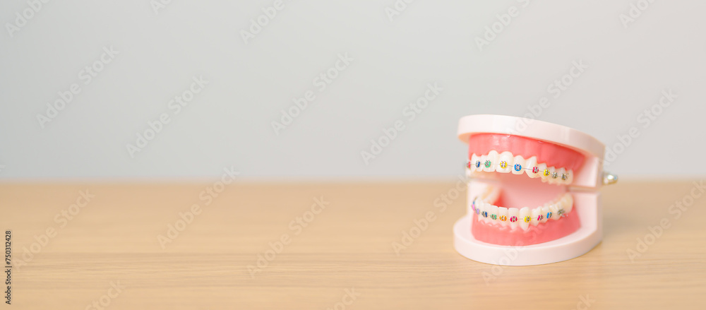 Orthodontic tooth model and bracket or brace. Clean and Scrape off ...