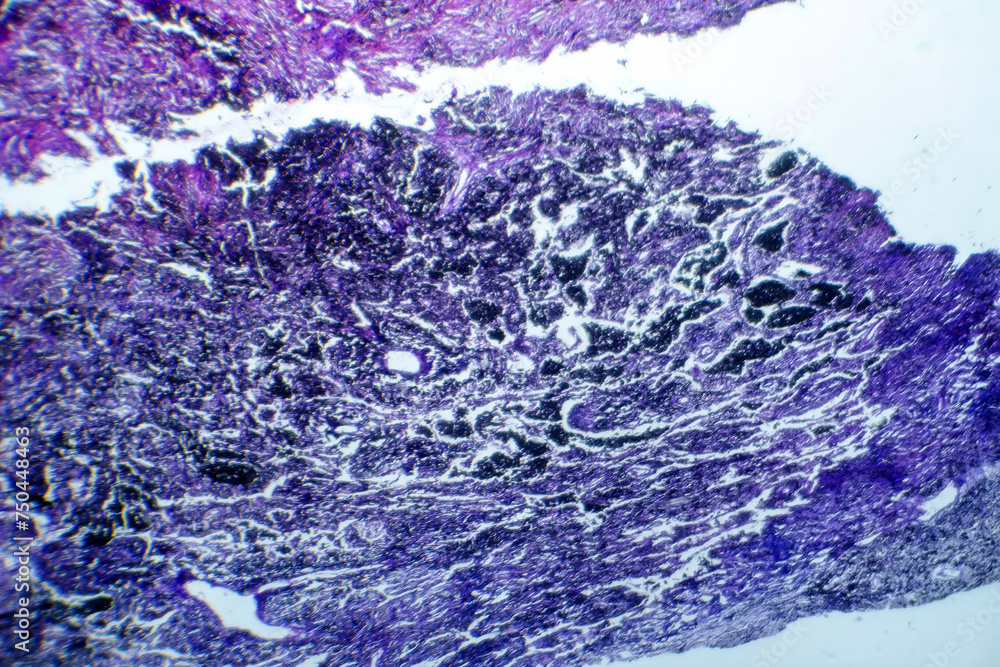 Photomicrograph of lung tissue with silicosis pathology under a ...