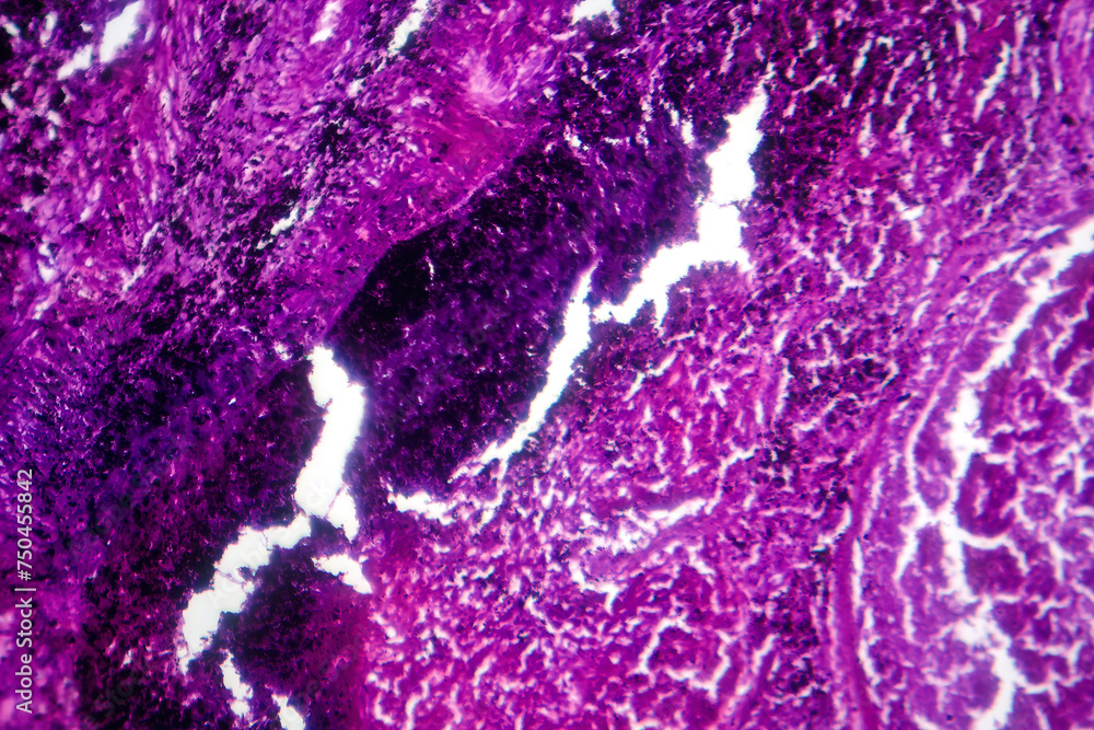 Poster Photomicrograph of lung tissue with silicosis pathology under a ...