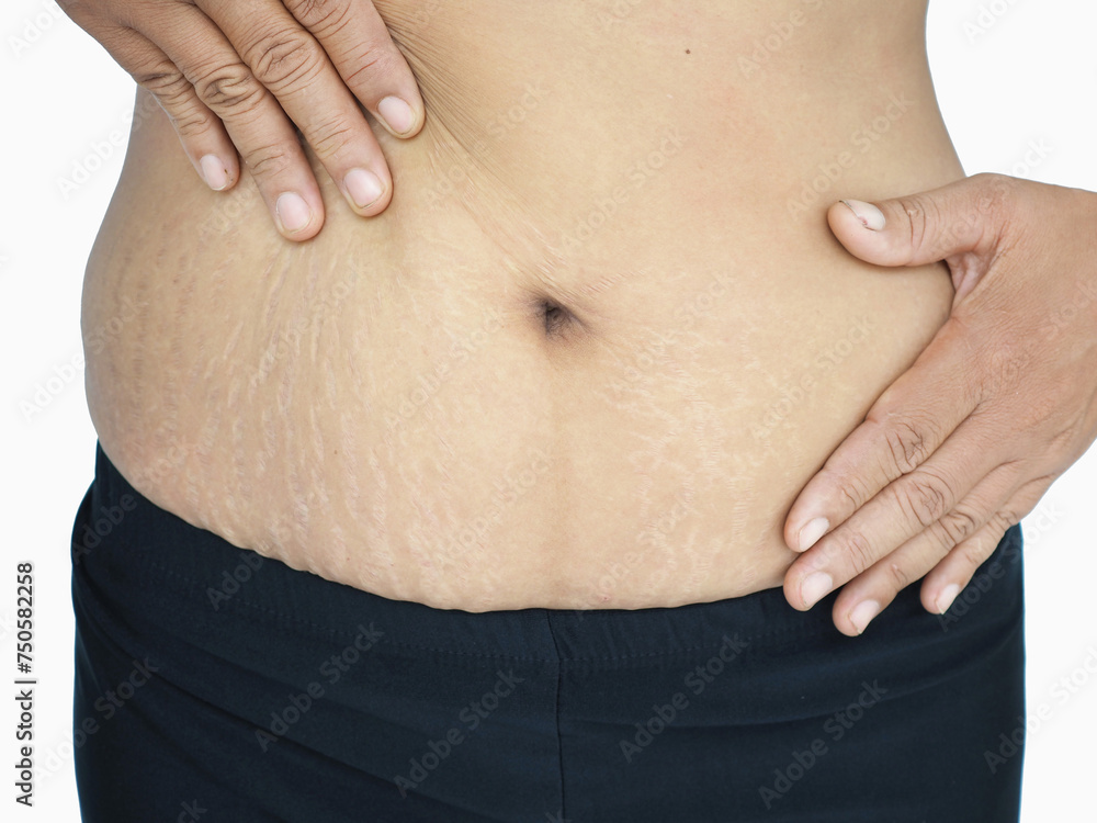 Asian woman show off displaying stretch marks on her abdomen after ...