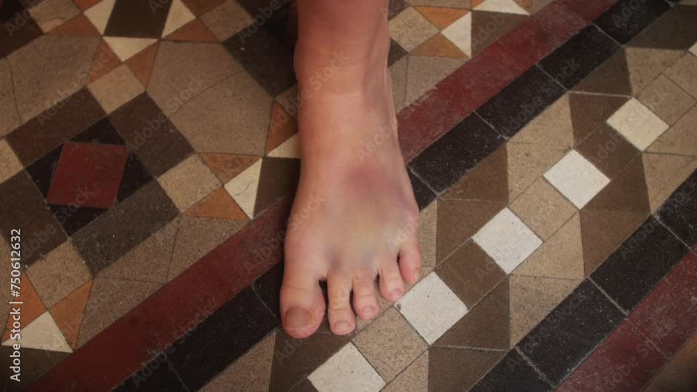 Close-up of bruise on the foot, a sprain and a bruise on the leg, the ...
