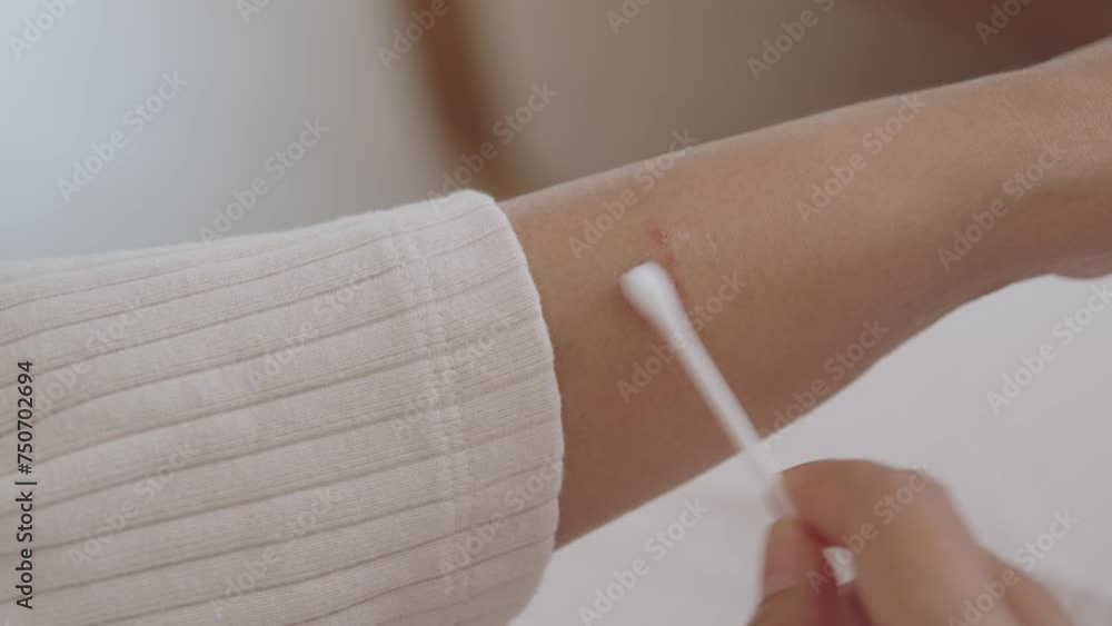 Young Asian woman applies medicine to red spots or skin rashes on her ...