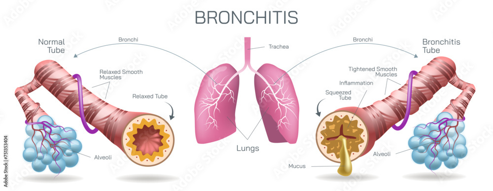 Bronchitis is an inflammation of the bronchial tubes, which are the air ...