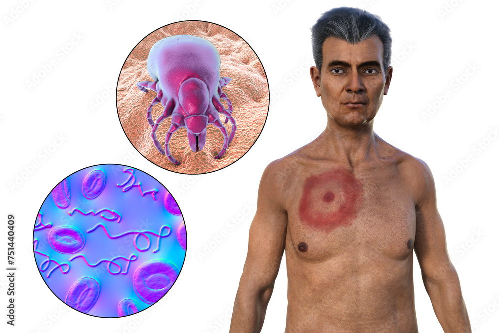 A man with erythema migrans, a characteristic rash of Lyme disease ...