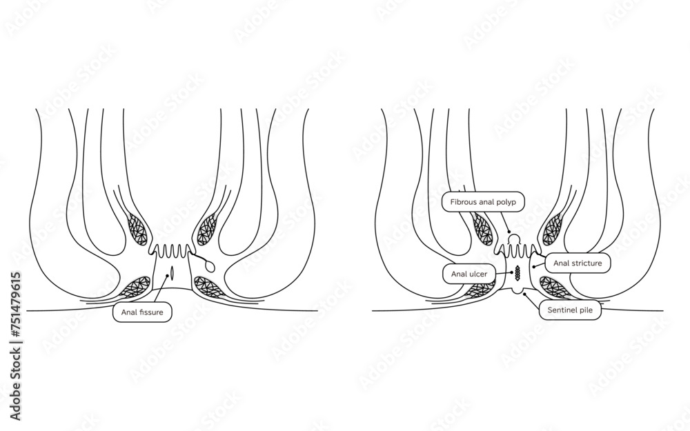 Diseases of the anus, hemorrhoids "anal hemorrhoid, anal ulcer, anal ...