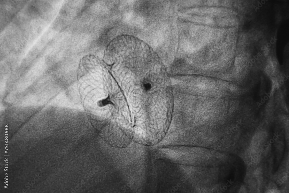 ASD or VSD closure device was deployed under transesophageal ...