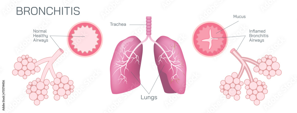 Bronchitis is an inflammation of the bronchial tubes, which are the air ...