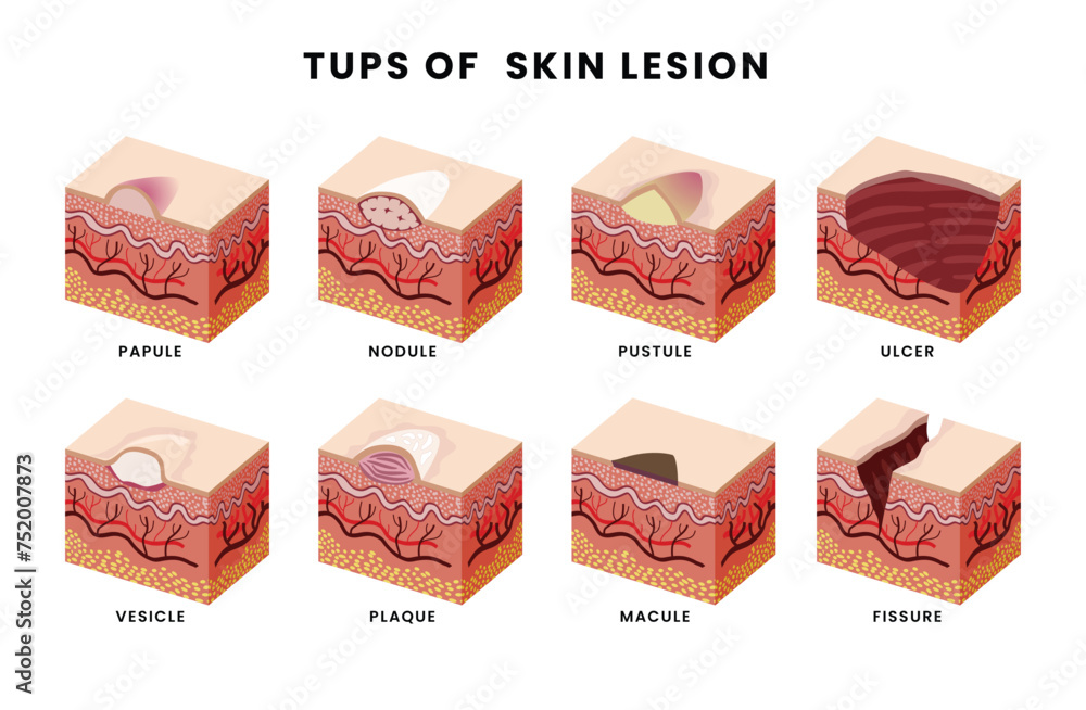 Types of skin lesion set collection for education poster, acne skin layers dermatology,skin ...