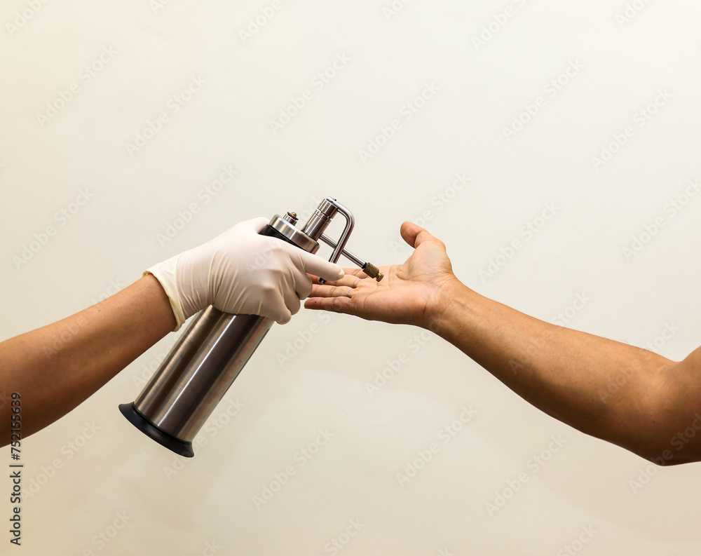 Dermatologists use liquid nitrogen to treat hand scar, Cryotherapy ...