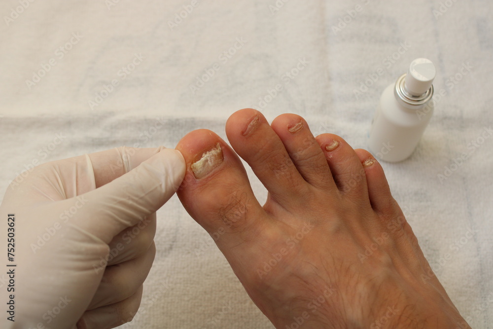 dermatologist examining patient with toenail fungus. A doctor examines ...