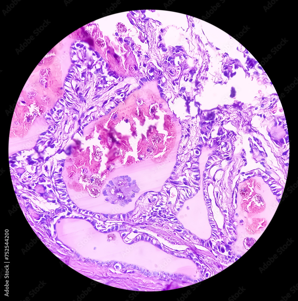 Thyroid cancer, Papillary thyroid microcarcinoma with nodular colloid ...