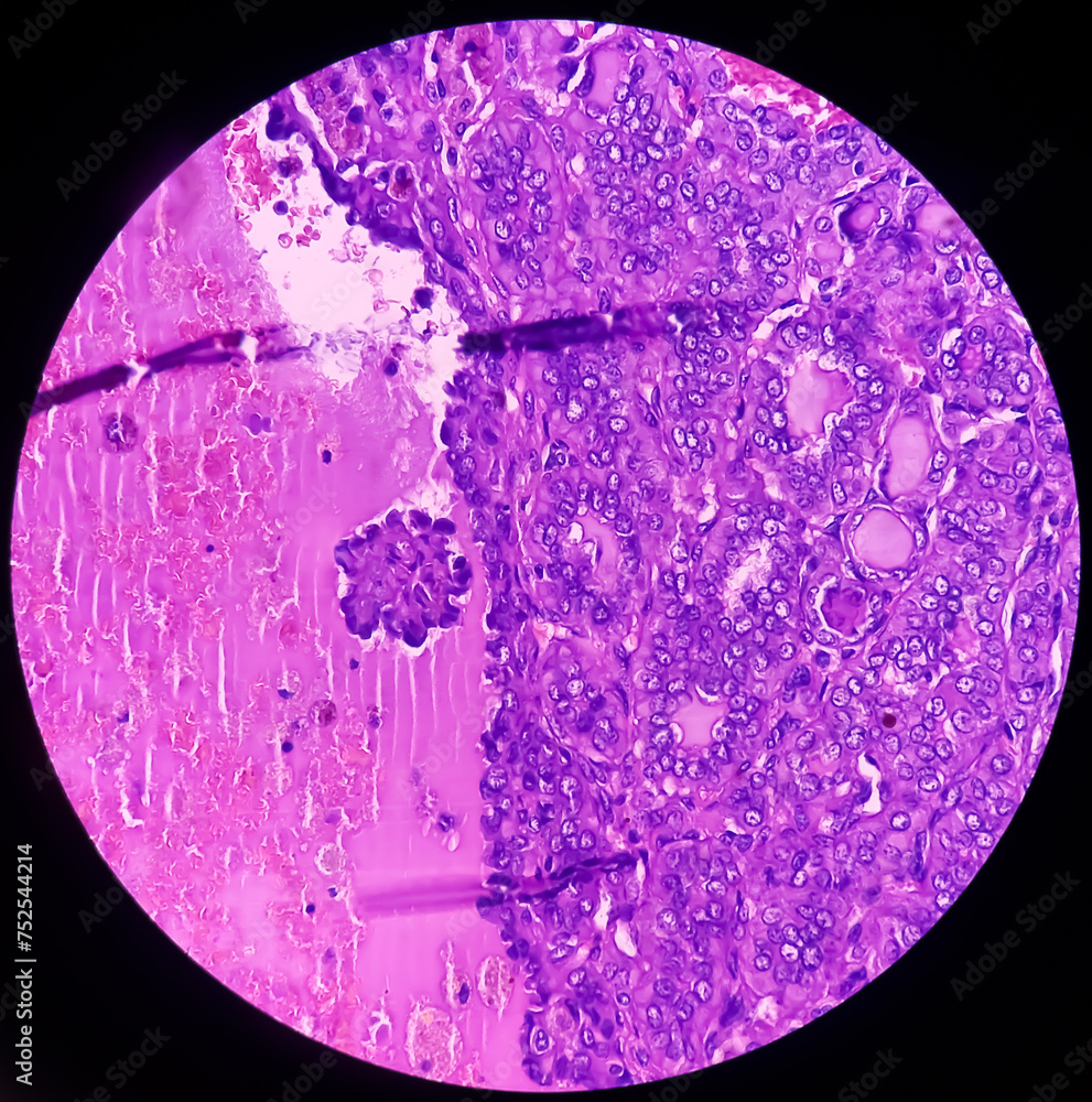 Thyroid cancer, Papillary thyroid microcarcinoma with nodular colloid ...