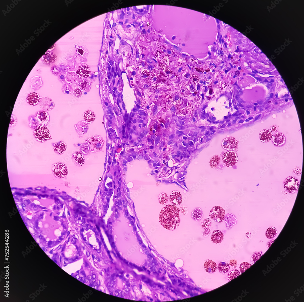 Thyroid cancer, Papillary thyroid microcarcinoma with nodular colloid ...