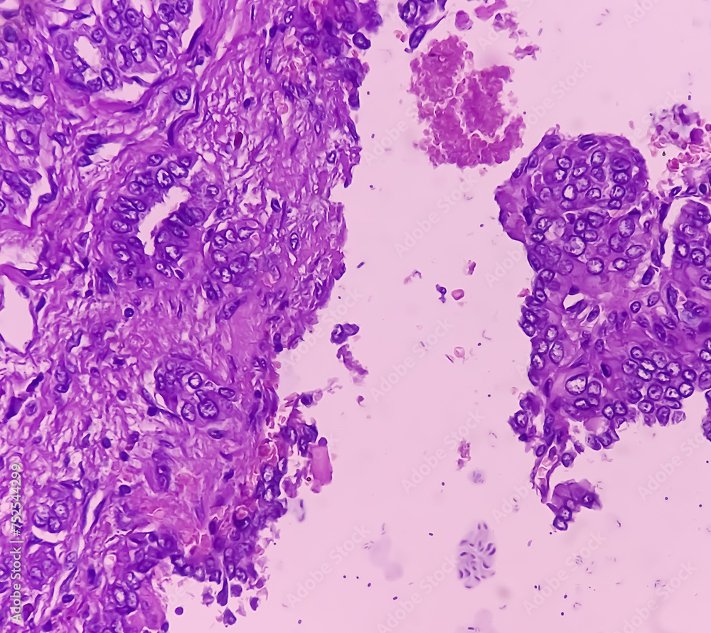 Thyroid cancer, Papillary thyroid microcarcinoma with nodular colloid ...