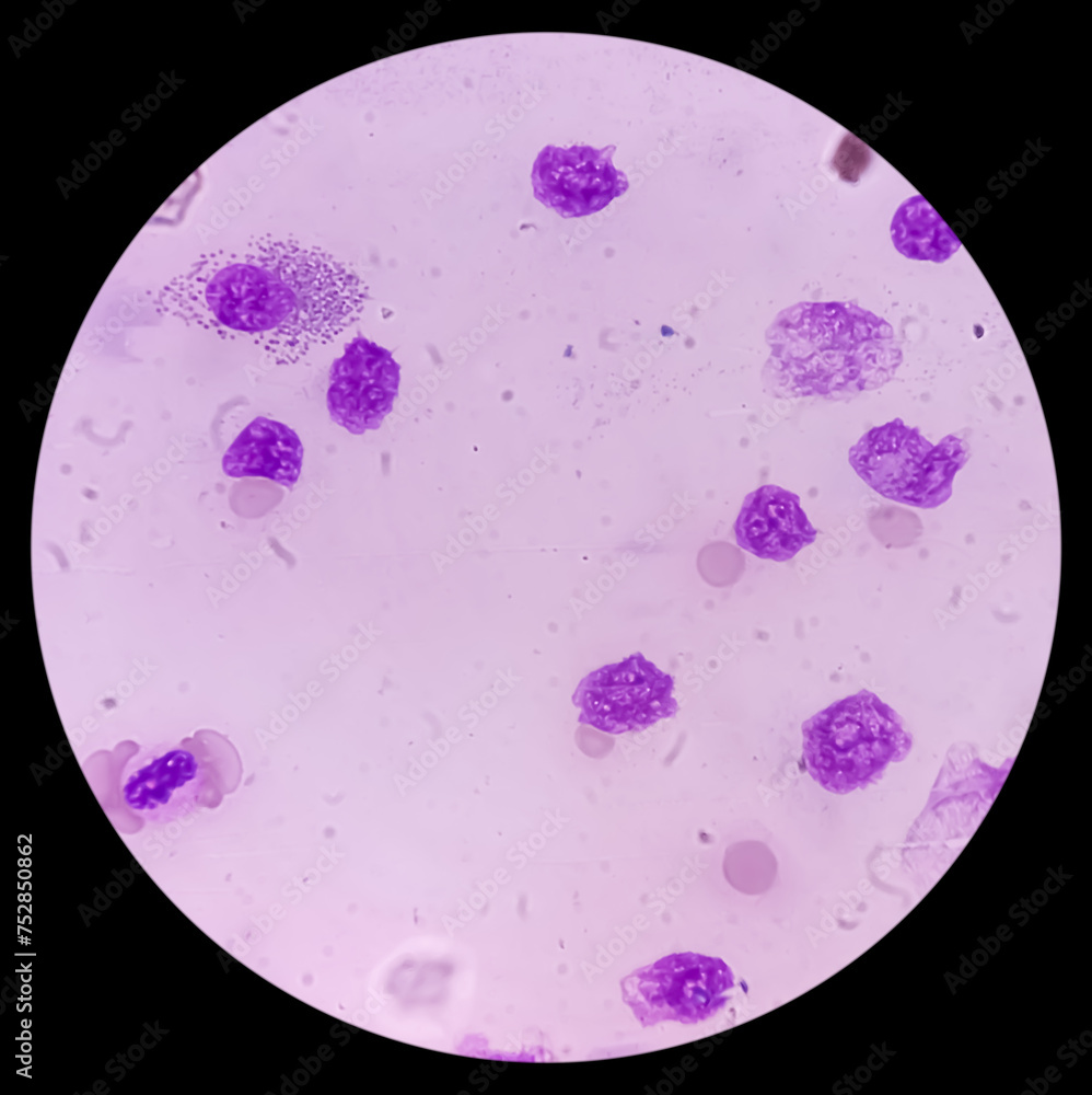 Blood cancer. Photomicrograph of Acute Myeloblastic Leukemia or AML, a ...