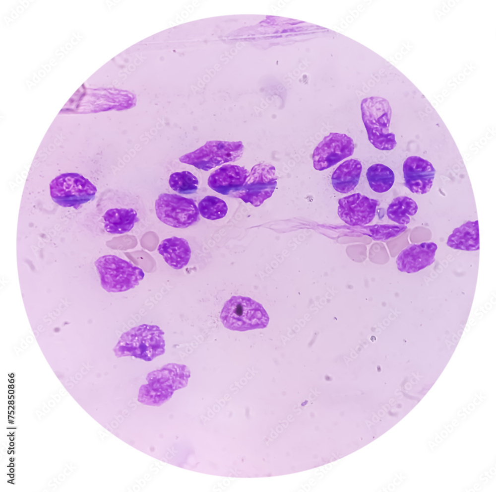 Blood cancer. Photomicrograph of Acute Myeloblastic Leukemia or AML, a ...