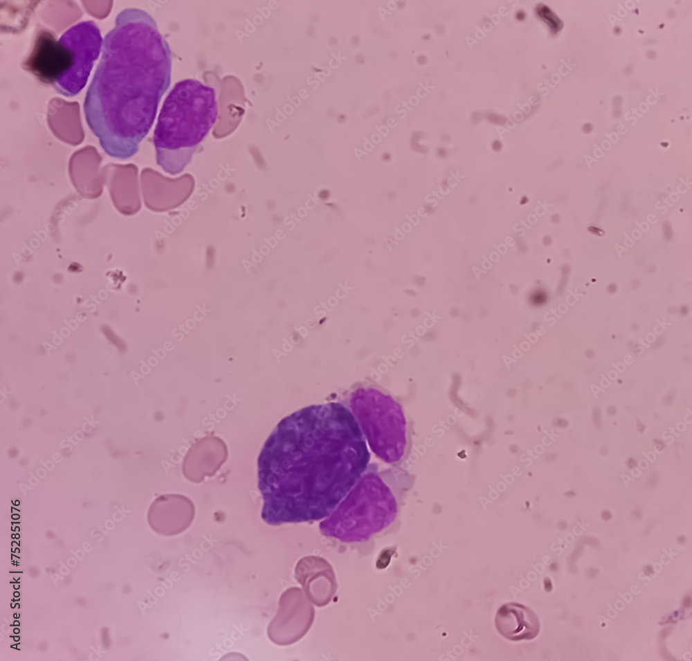 Blood cancer. Photomicrograph of Acute Myeloblastic Leukemia or AML, a ...