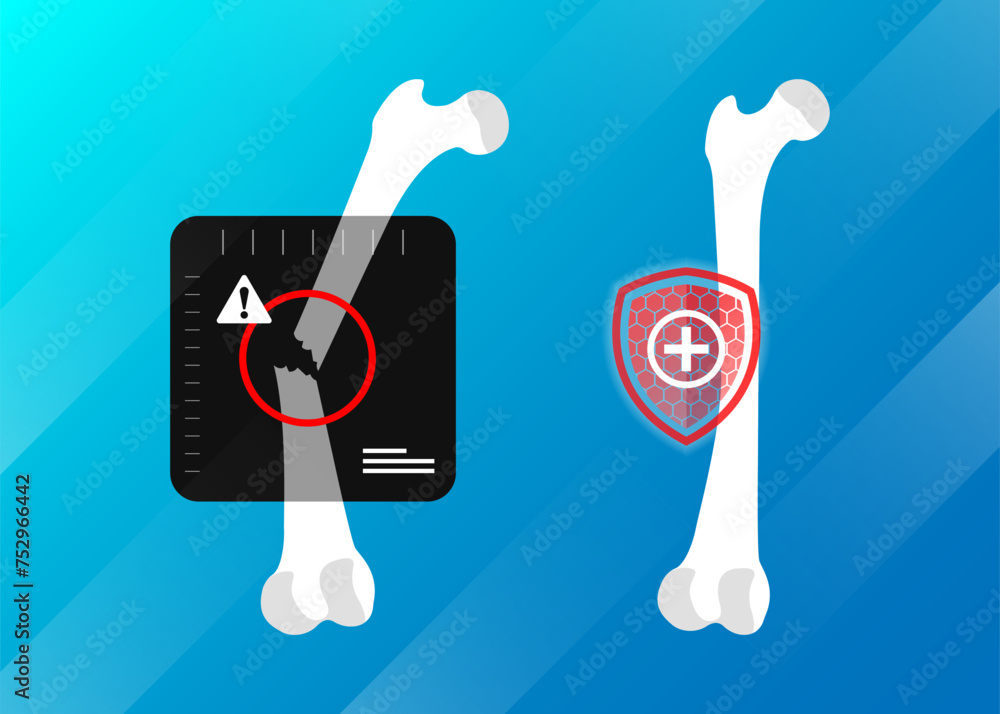 Broken Bone x ray Human skeleton anatomy concept. Medical banner for ...