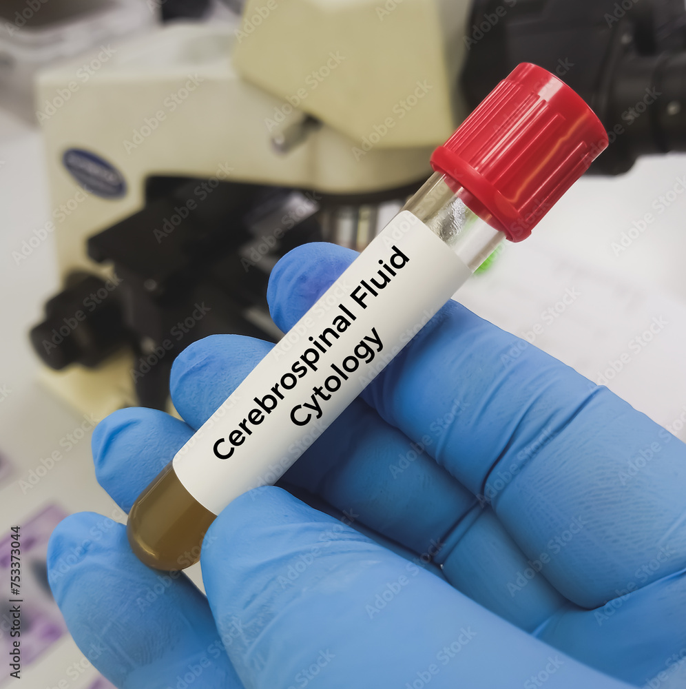 CSF study. Cerebrospinal fluid (CSF) cytology testing. Stock Photo ...