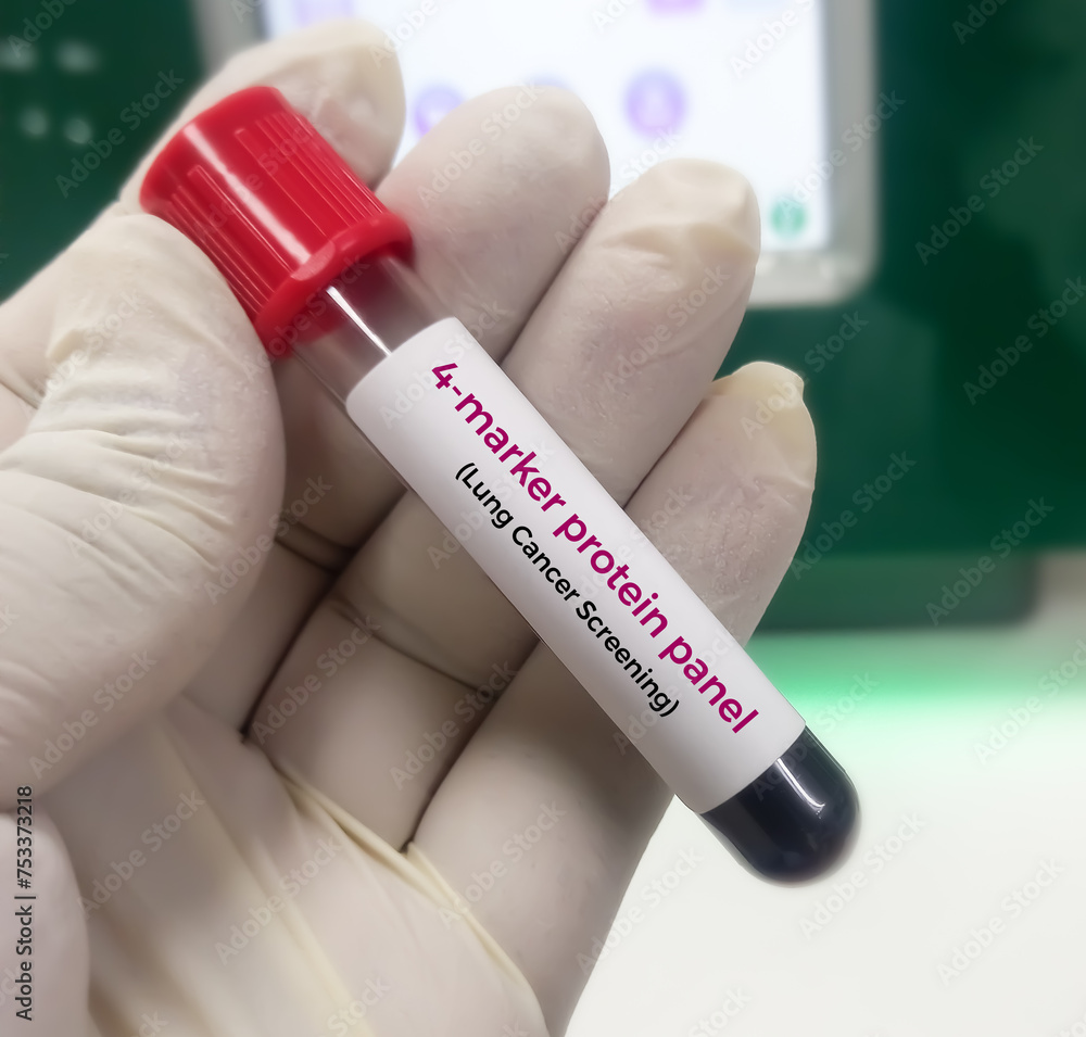 Blood sample for blood-based four-marker protein (4MP) panel, can help ...
