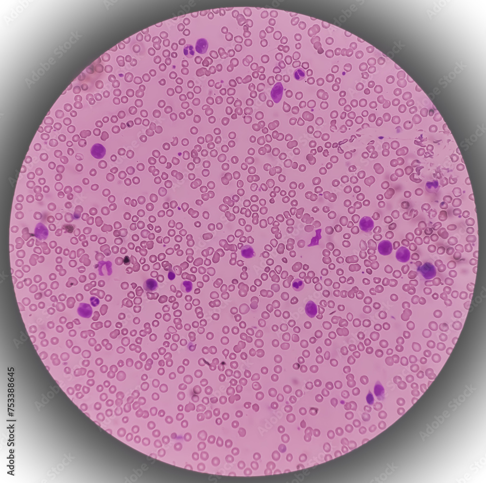 Leukemia. Photomicrograph of hematological blood slide showing ...