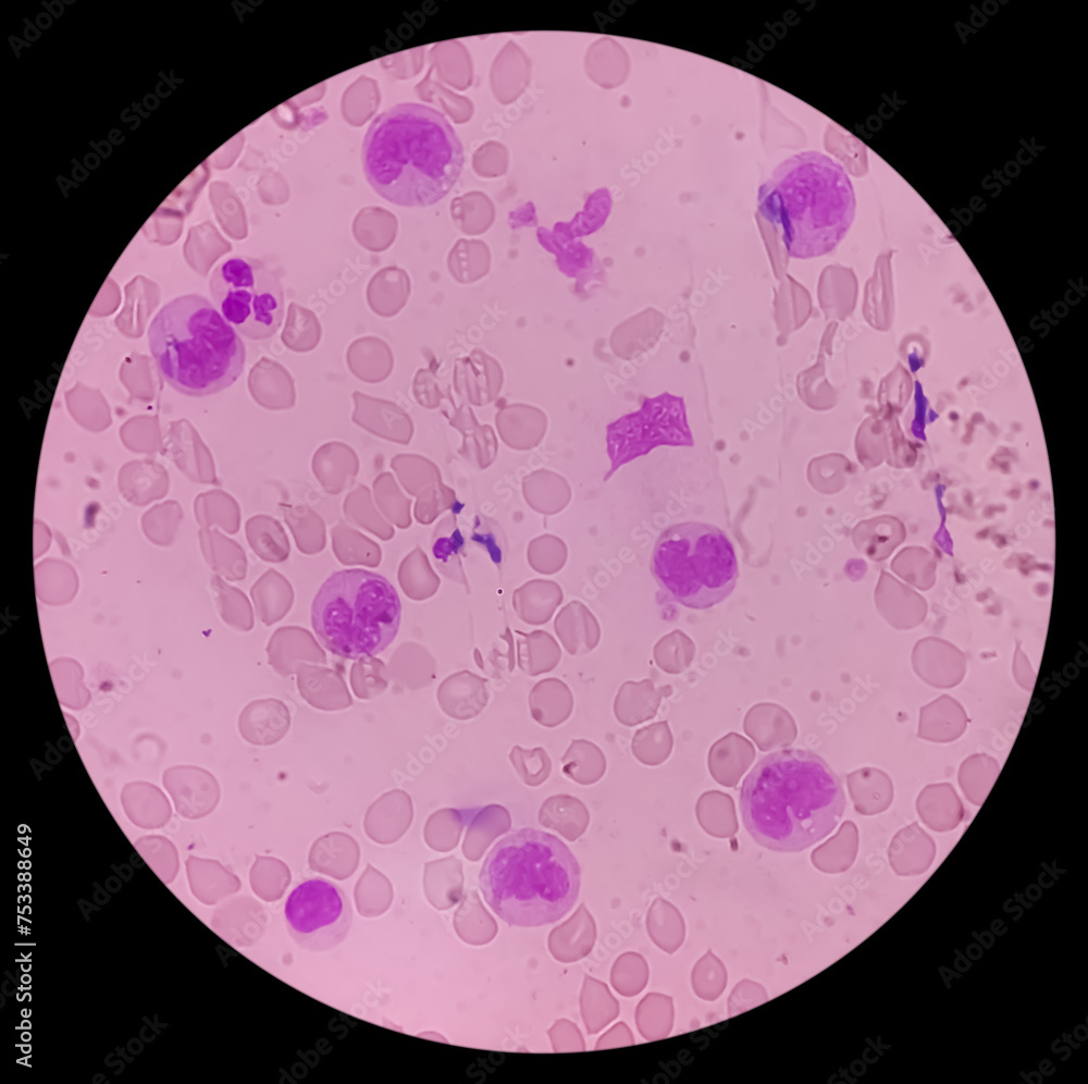 Leukemia. Photomicrograph of hematological blood slide showing ...