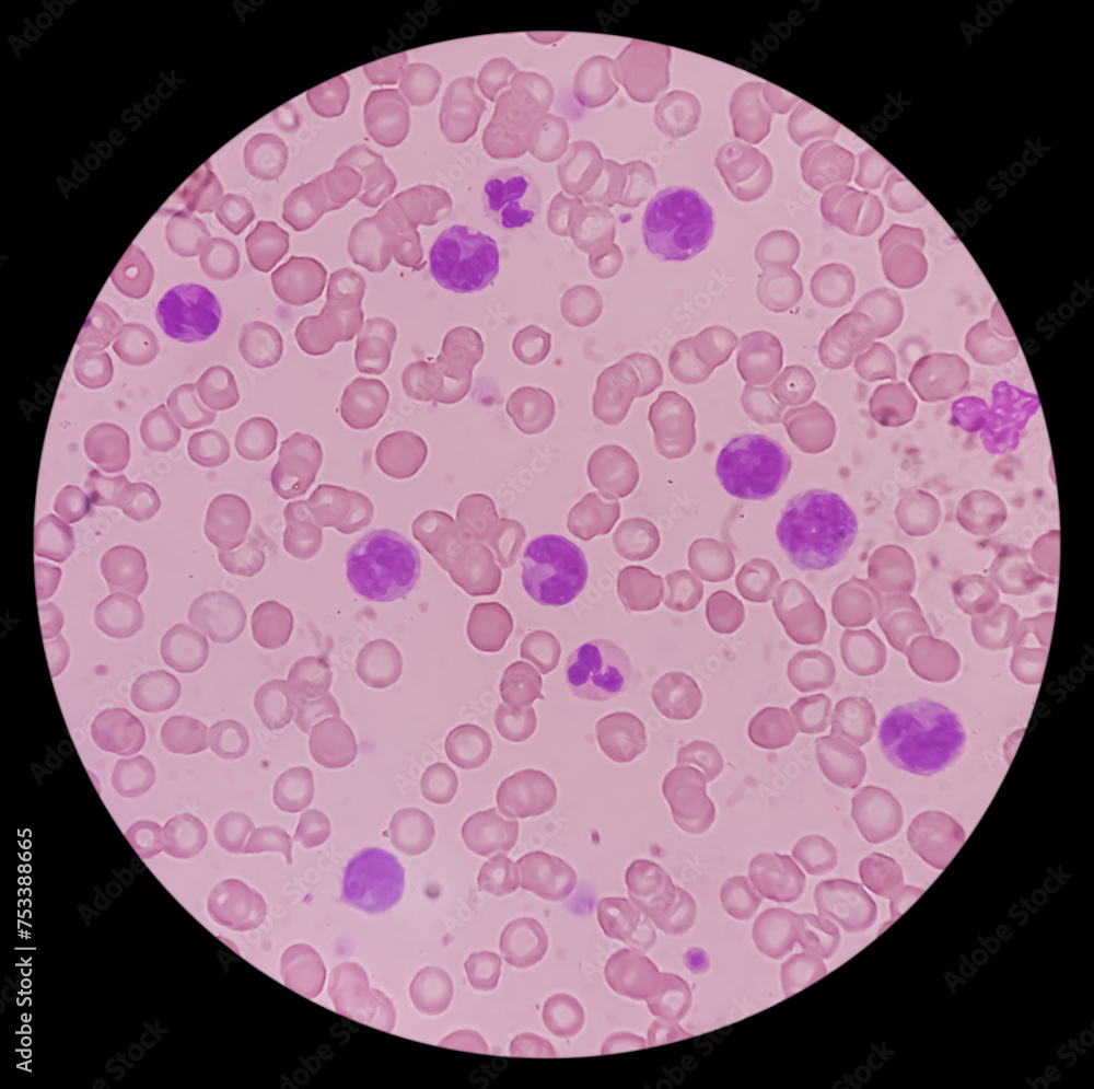 Foto de Leukemia. Photomicrograph of hematological blood slide showing ...