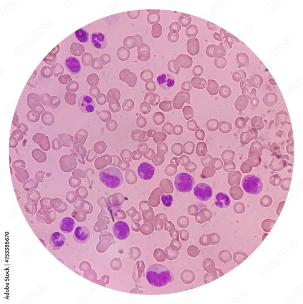 Leukemia. Photomicrograph of hematological blood slide showing ...