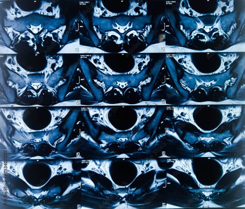 MRI (magnetic resonance imaging) of Lumbo sacral Spine. Degenerative ...