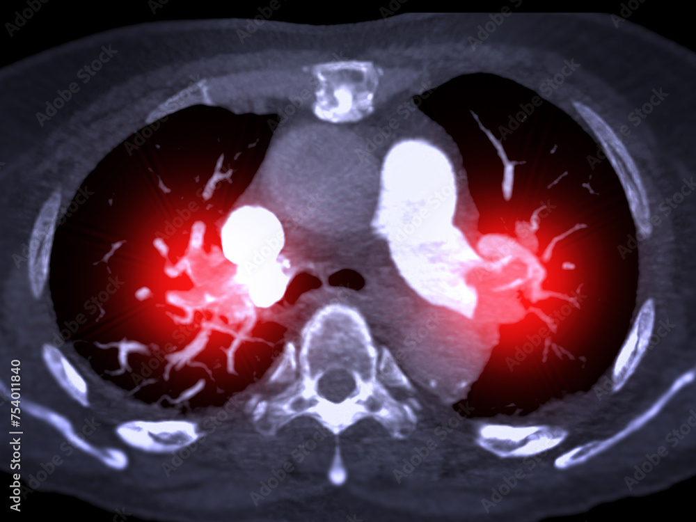 A CTA pulmonary artery reveals a detailed view of the lung blood ...