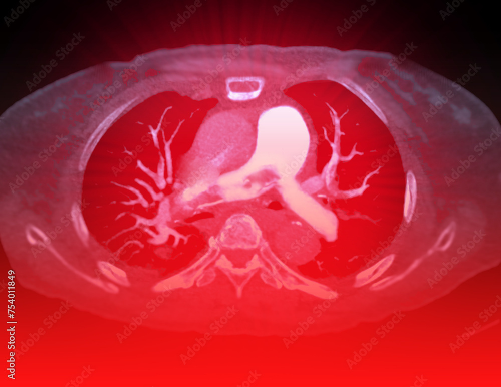 A CTA pulmonary artery reveals a detailed view of the lung blood ...