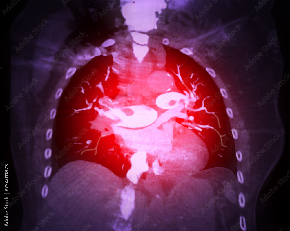 A CTA pulmonary artery reveals a detailed view of the lung blood ...