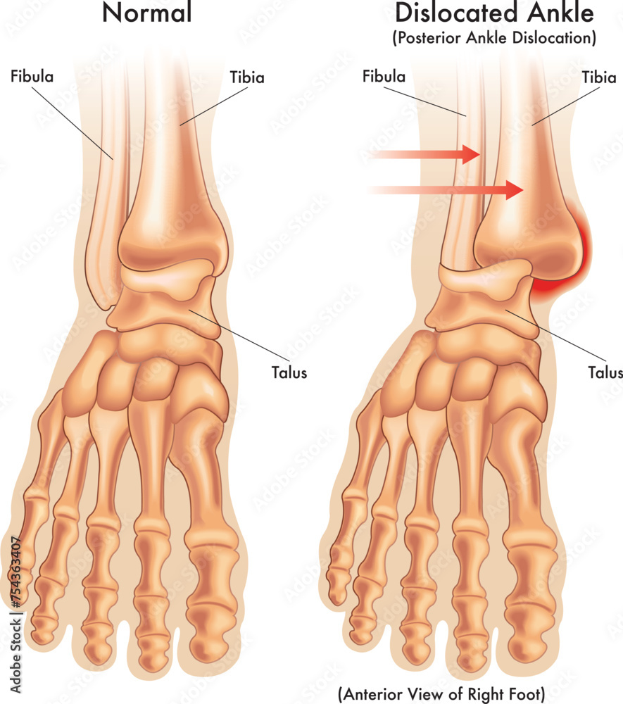 Medical illustration comparing a normal ankle, with a dislocated ankle ...