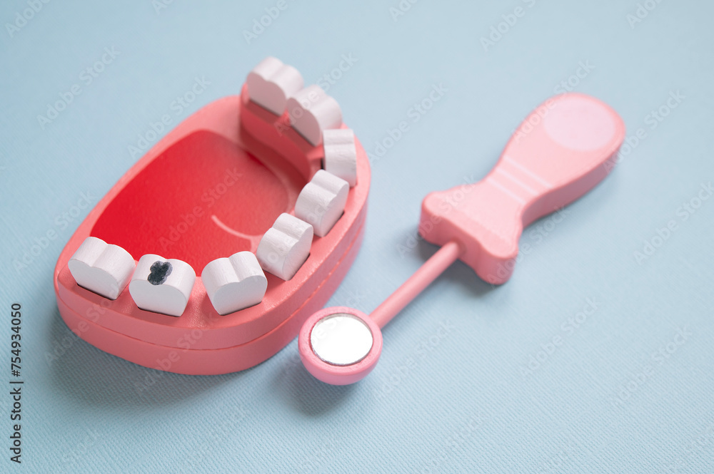 Tooth decay (cavities or caries). Model of a jaw with teeth on a blue ...