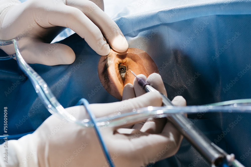 Vision correction with microscope. Surgeon's hands in gloves performing ...