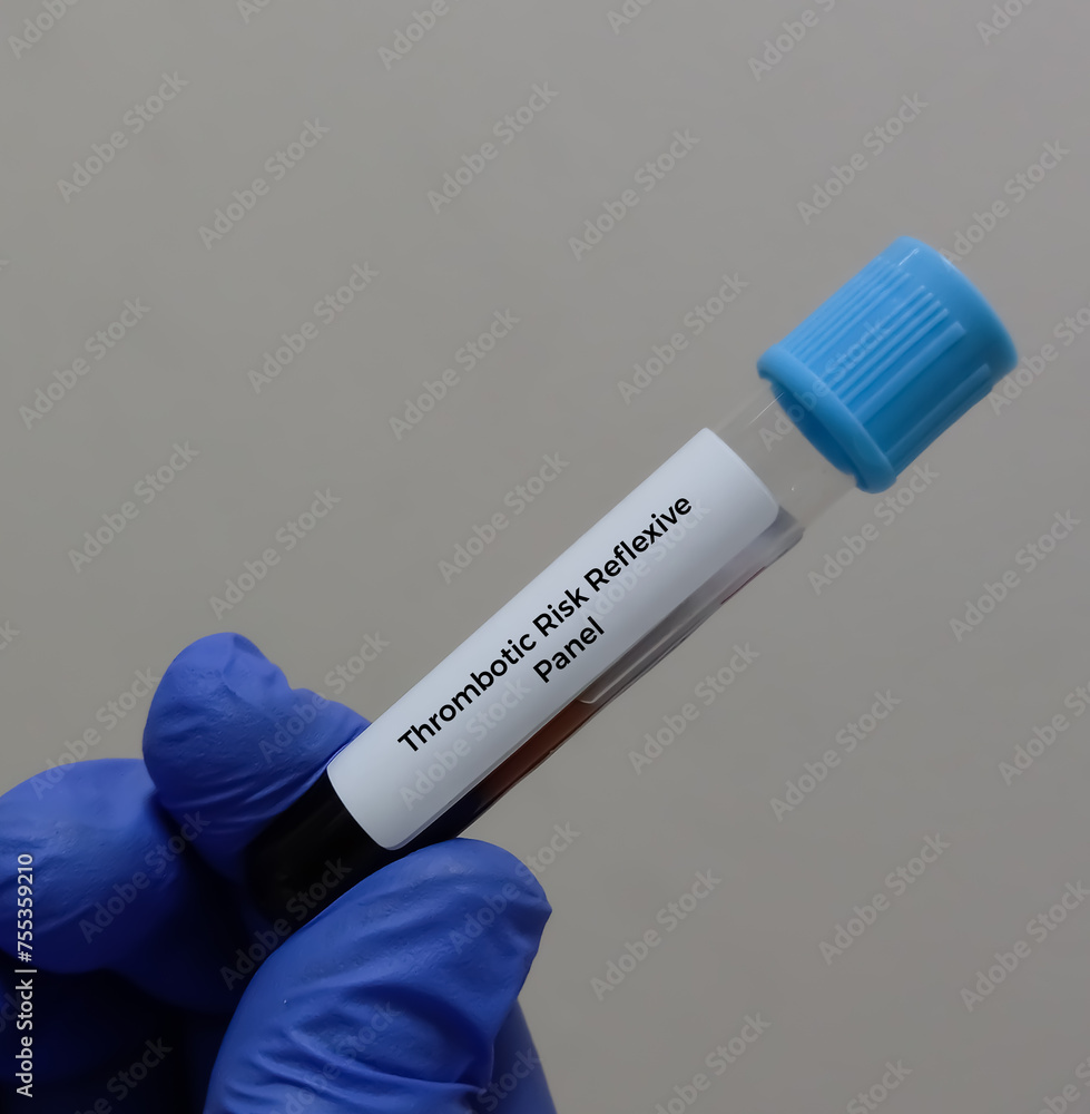 Blood sample for Thrombotic Risk Reflexive Panel to diagnosis or ...