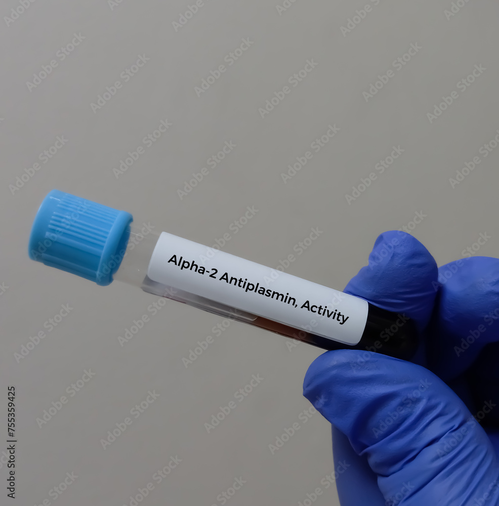 Blood sample for Alpha 2-antiplasmin, activity test for diagnosing ...